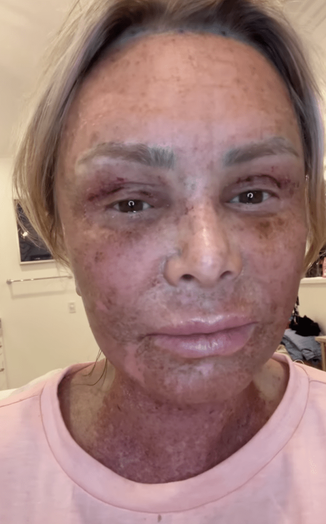Tamra Judge Shows Off Healed Face After $15K Brow Lift and Chemical Peel