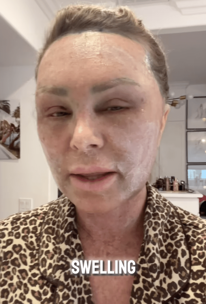 Tamra Judge Shows Off Healed Face After $15K Brow Lift and Chemical Peel